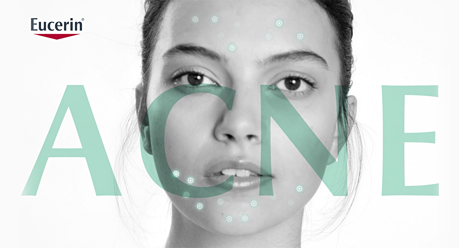 GETTING THROUGH THE YEARS WITH MILD ACNE