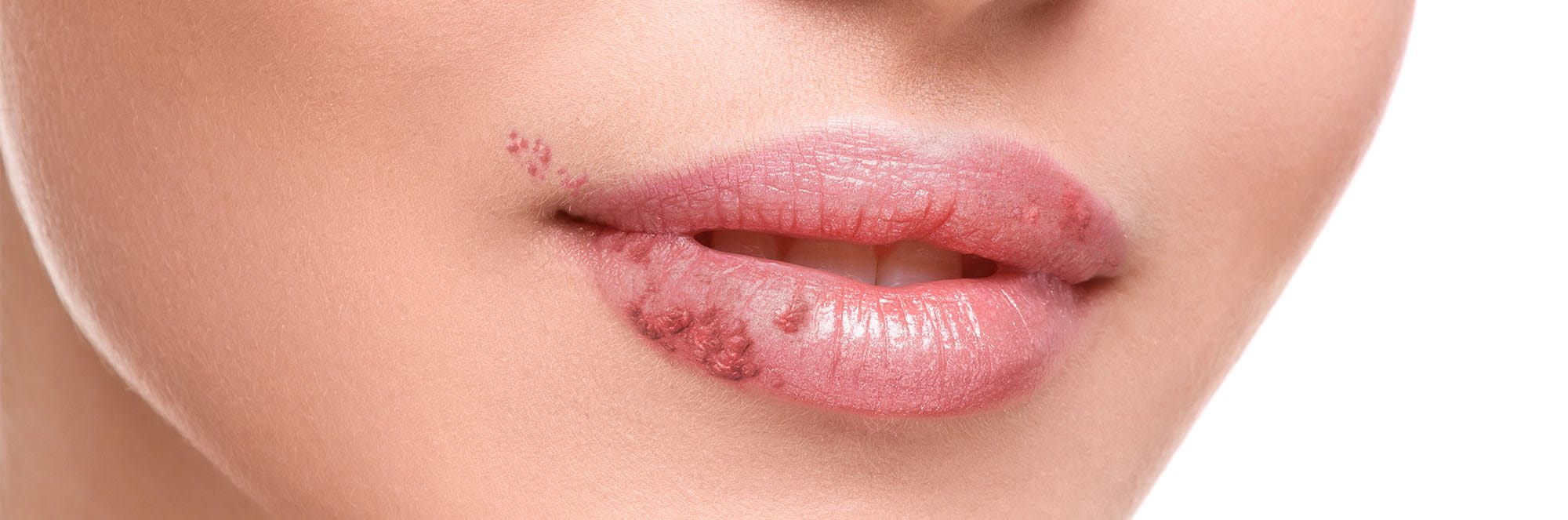 Herpes labiale: cause, rimedi e prevenzione | Eucerin