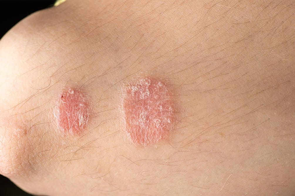 Eczema nummulare: cause, rimedi e prevenzione | Eucerin