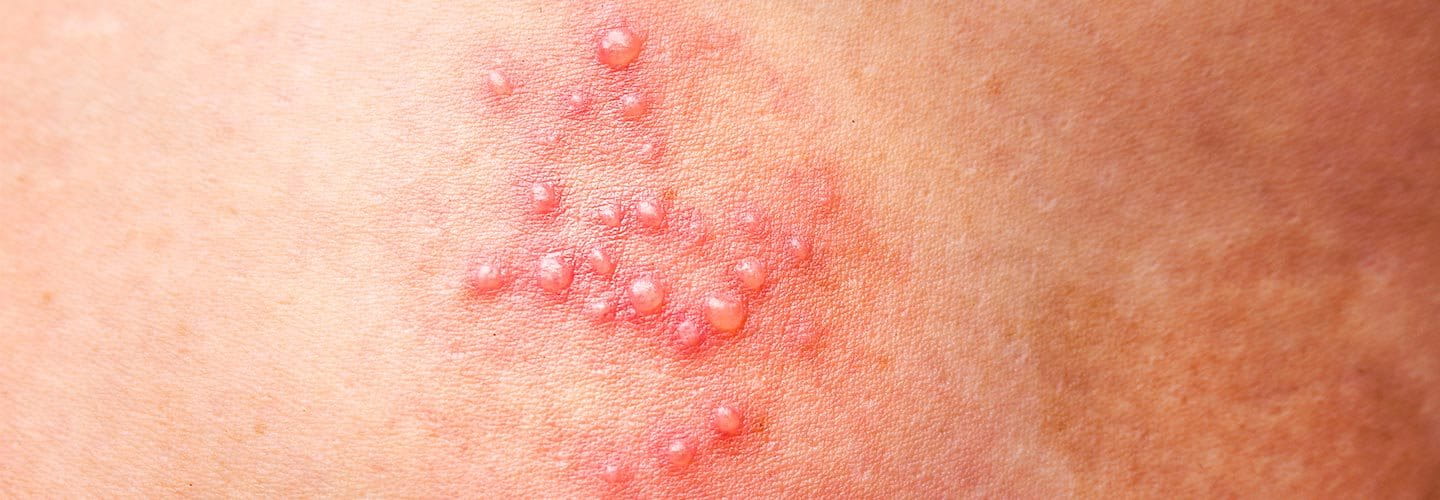 Bolle sulla pelle: tutte le cause delle bolle cutanee | Eucerin