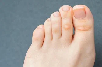 Callos: qué son, causas y remedios para la hiperqueratosis | Eucerin