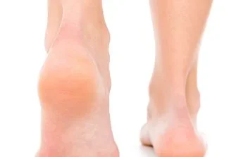 Callos: qué son, causas y remedios para la hiperqueratosis | Eucerin