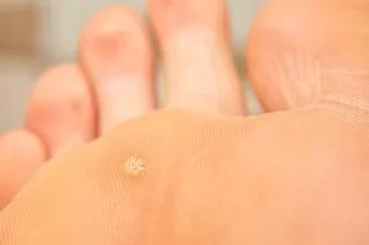 Callos: qué son, causas y remedios para la hiperqueratosis | Eucerin