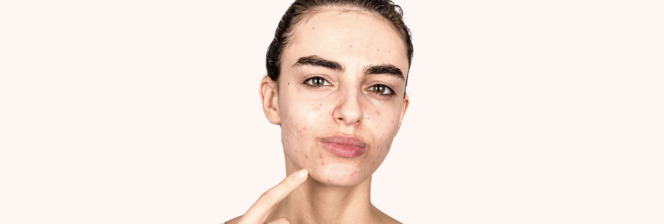 Acné en facial: causas, síntomas y tratamientos | Eucerin®
