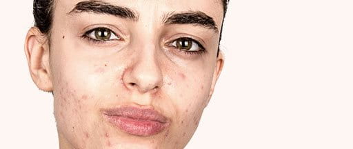 Imperfecciones faciales: causas, síntomas y tratamientos | Eucerin®