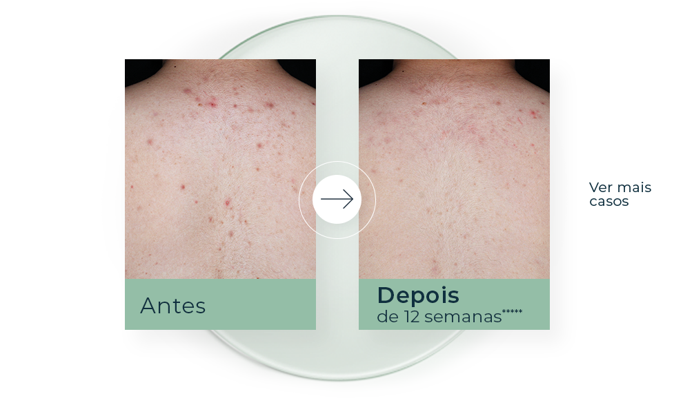 Reduza a acne corporal e as manchas na pele