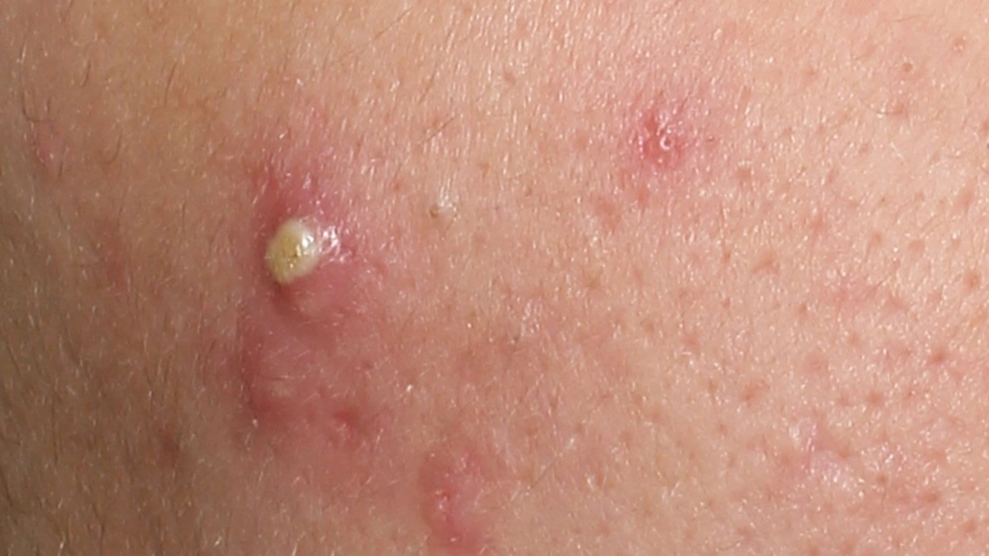 DERMOPURE CLINICAL Triple Action corrective fluid | Acne Prone Skin ...