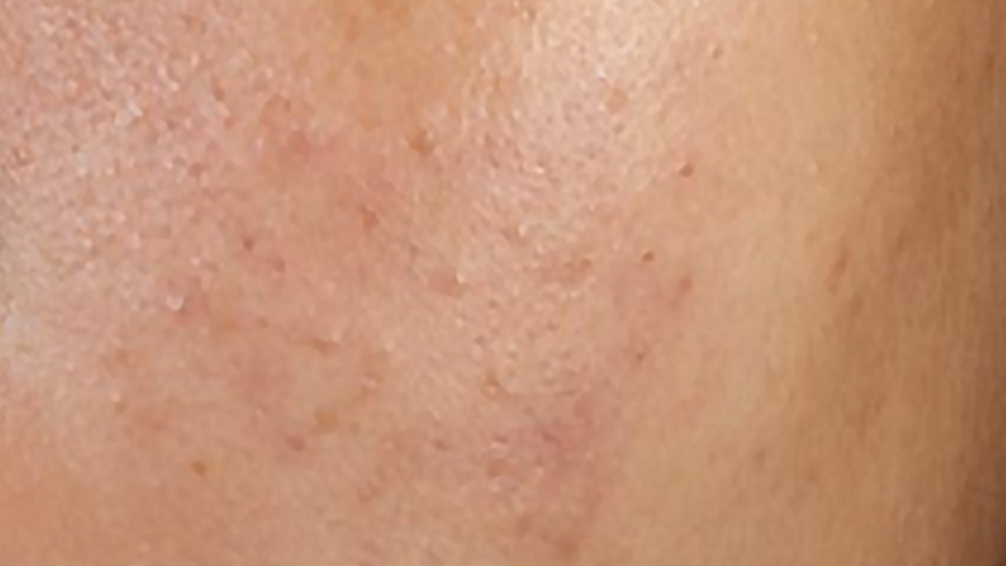DERMOPURE CLINICAL Peeling 10 | Acne Prone Skin | DERMOPURE CLINICAL ...