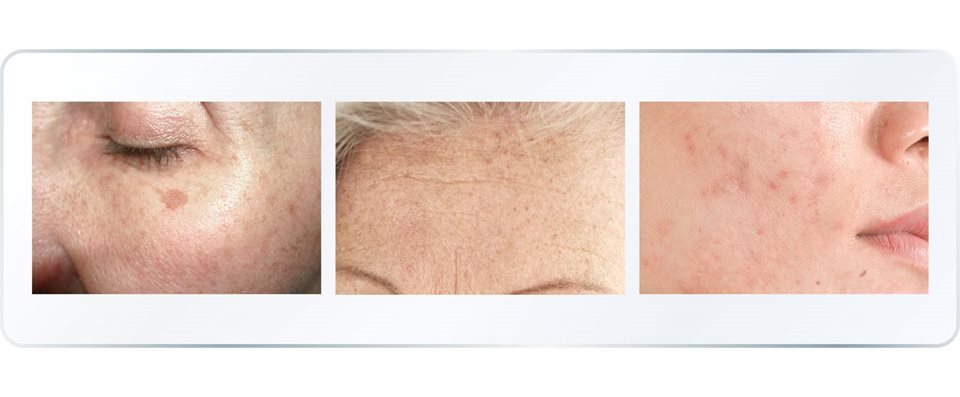 Anti-taches brunes – La solution Eucerin ANTI-PIGMENT | EUCERIN