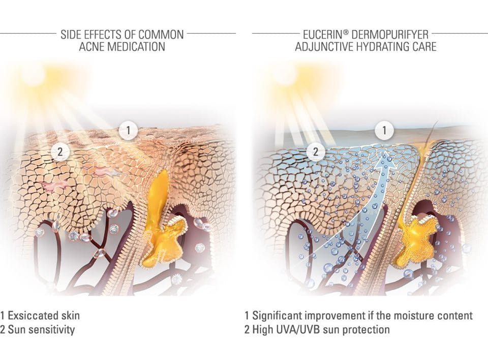 Acne treatment: Prescription Acne Medication for Adults | Eucerin