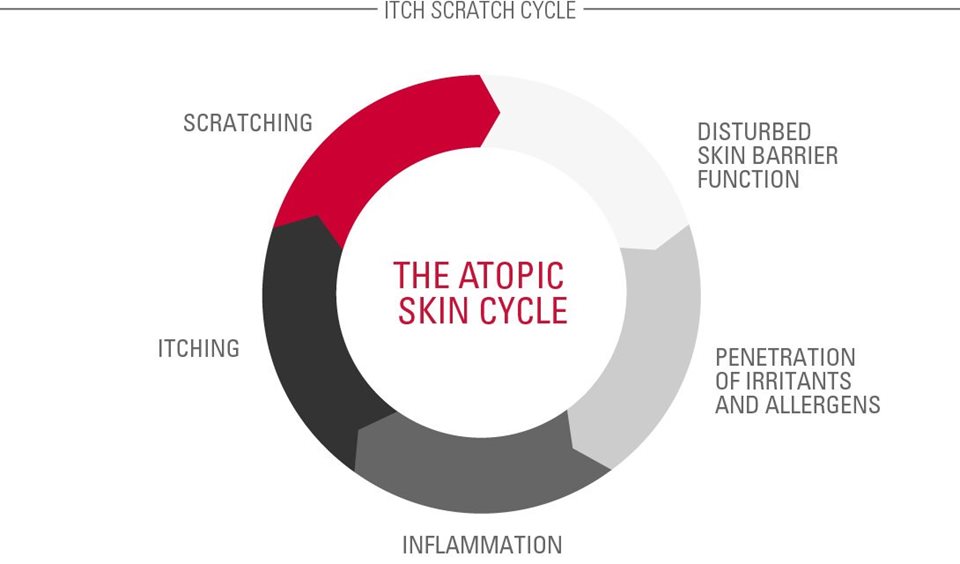 Skin Care: Atopic Dermatitis On The Body | Eucerin