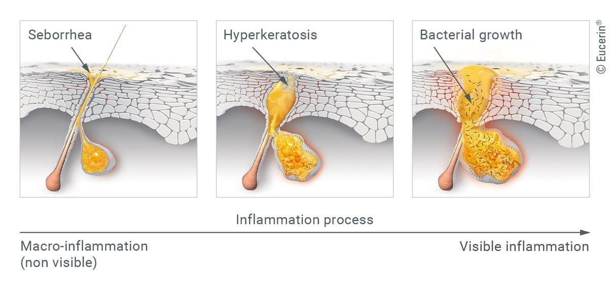Sun and acne-prone skin| Acne | Eucerin