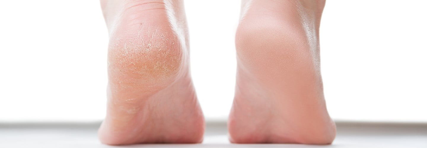 Schrunden und rissige Fersen: Wissenswertes | Eucerin