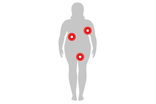 Akne inversa - Symptome erkennen und behandeln | Eucerin