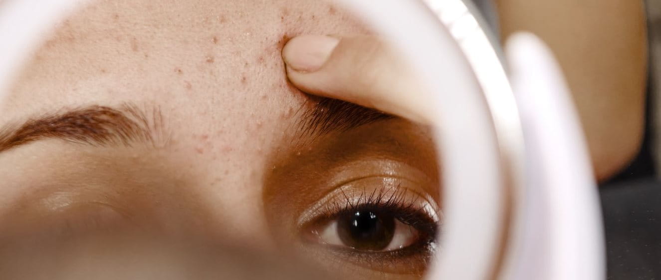 Akne und die verschiedenen Arten | Eucerin