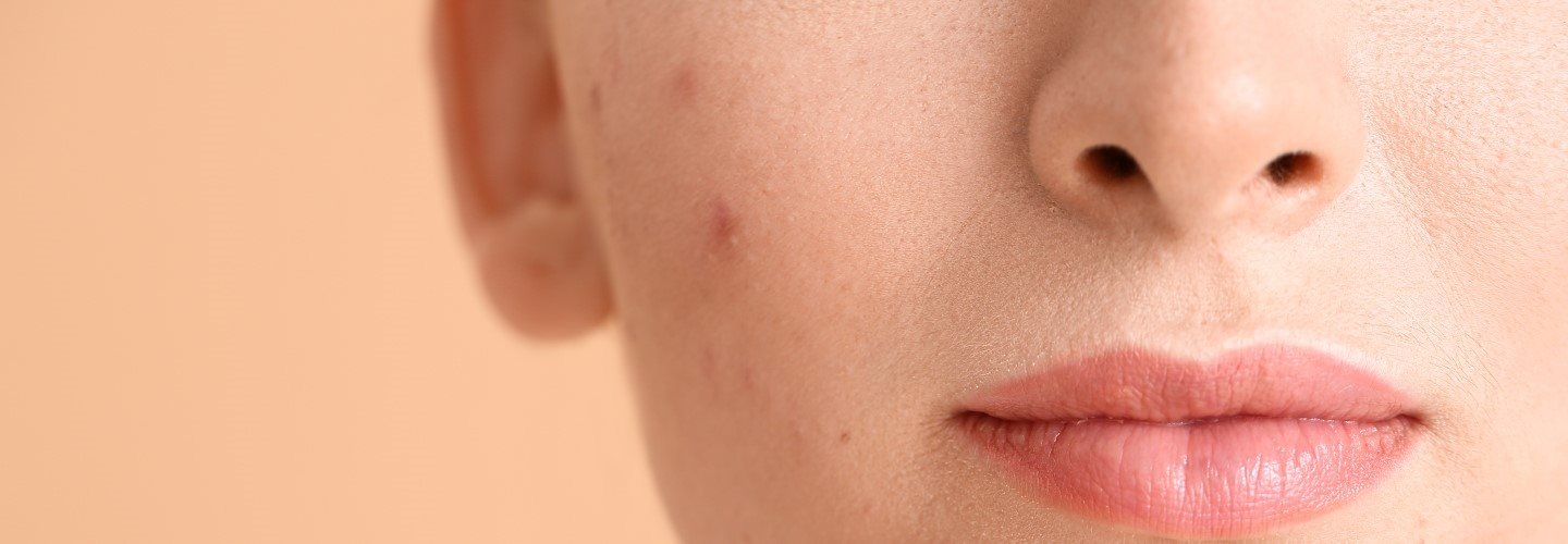 Entzündeter Pickel: Ursache, Symptome & Behandlung