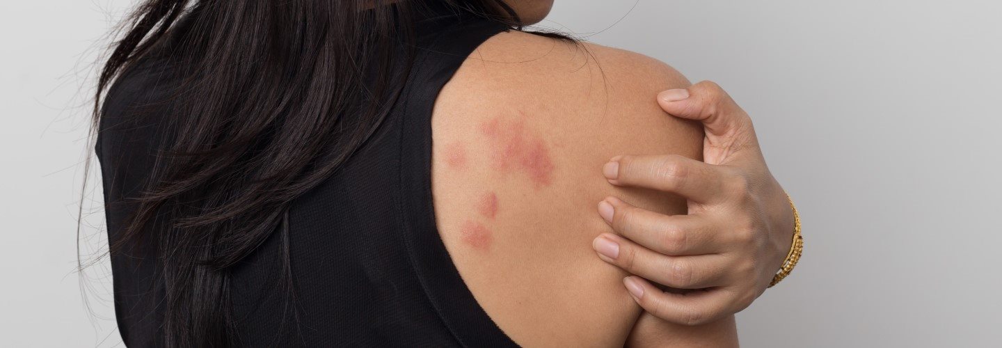 Nesselsucht – Ursachen, Symptome und Behandlung | Eucerin