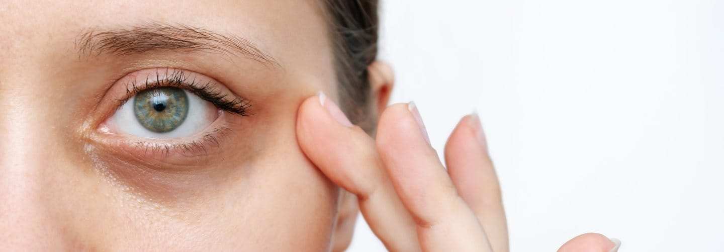Augenringe entfernen – Ursachen und Tipps bei Augenschatten
