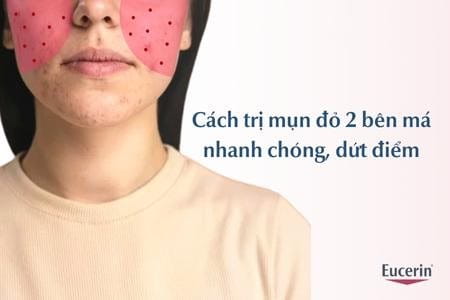 Cách Trị Mụn Đỏ 2 Bên Má Hiệu Quả Cấp Tốc Không Thâm Sẹo | Eucerin