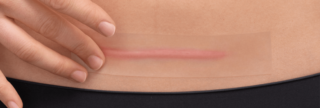 Get Rid of Scars: Best Treatments for Fading and Removal | Elastoplast