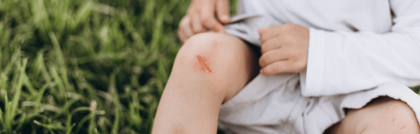 Offene Wunden richtig behandeln | Hansaplast