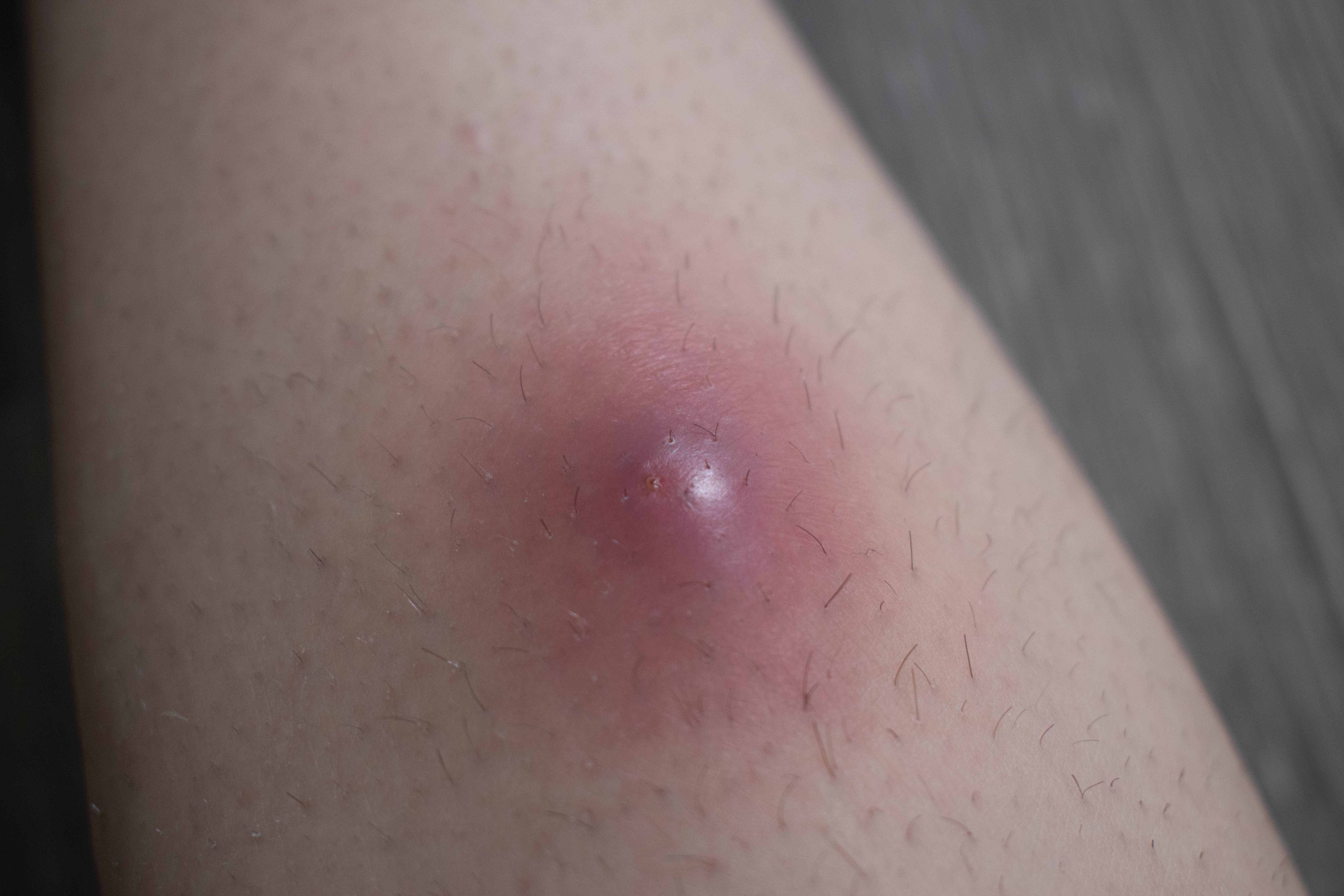 Wie entstehen Abszesse und was hilft dagegen?