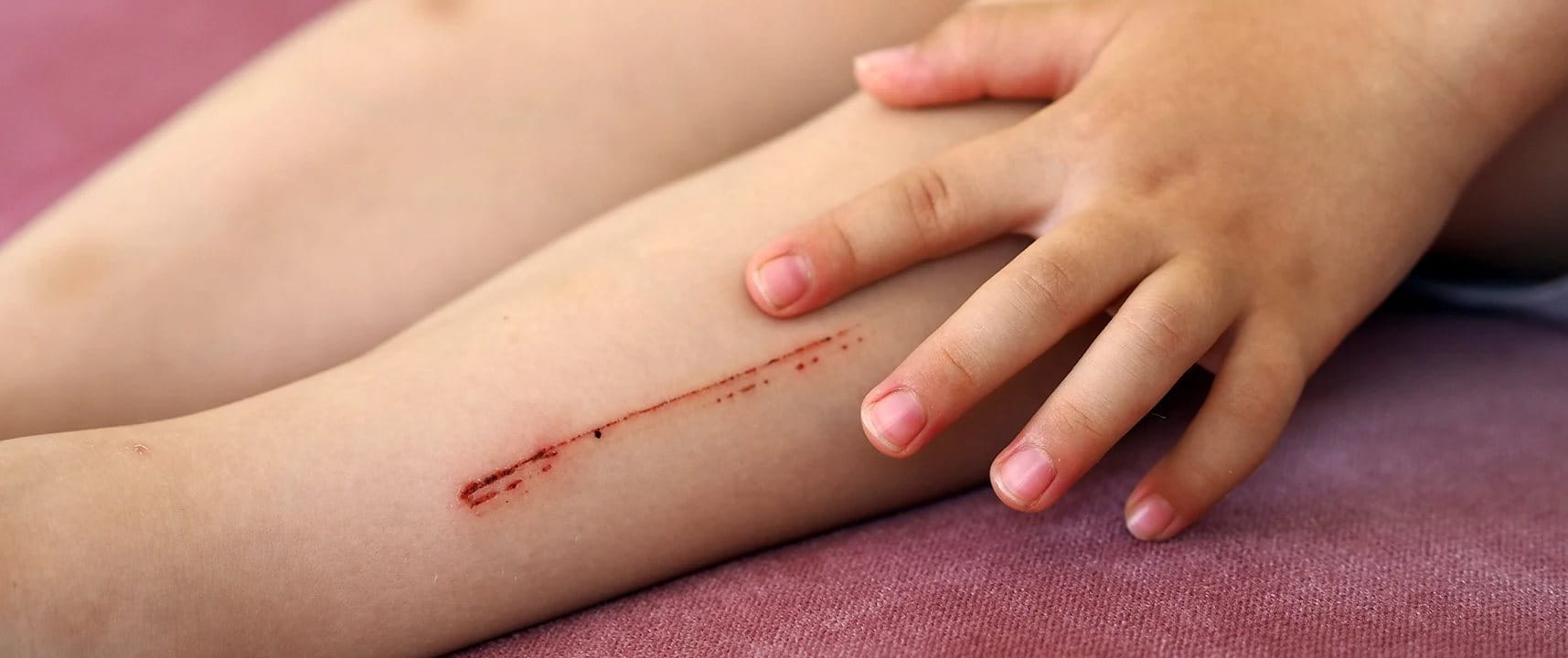 Perbedaan Luka Lecet dan Gores dan Bagaimana Perawatannya